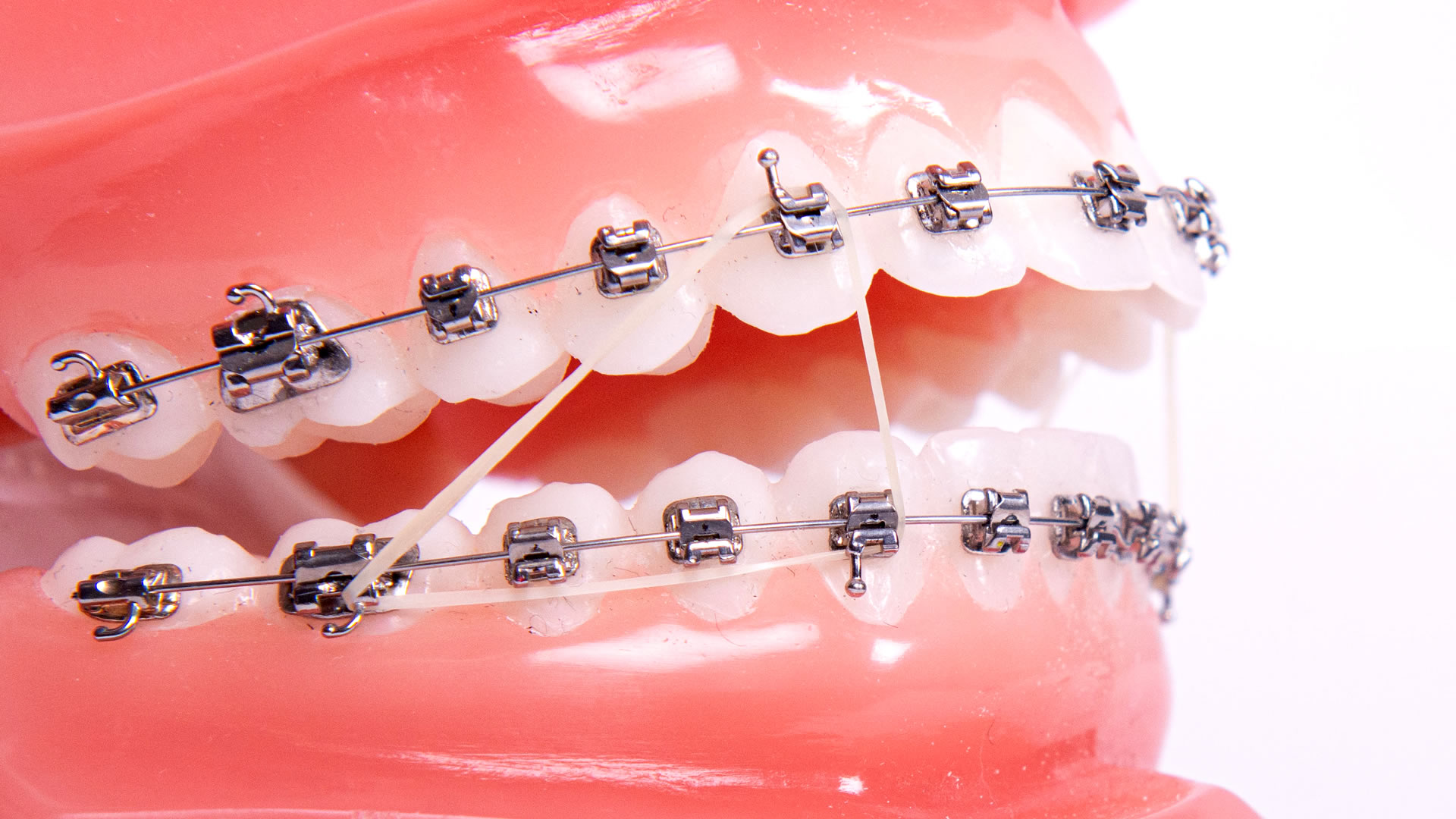 Vaste beugels - beugel